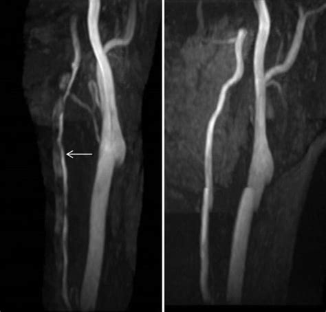 Vertebral Artery Dissection Found During Chiropractic Examination
